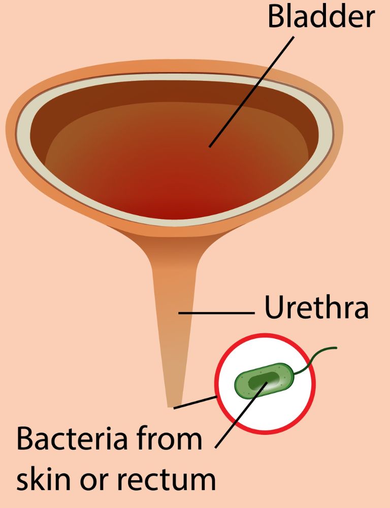 Urinary Tract Infection Discharge Urinary Tract Infection Different