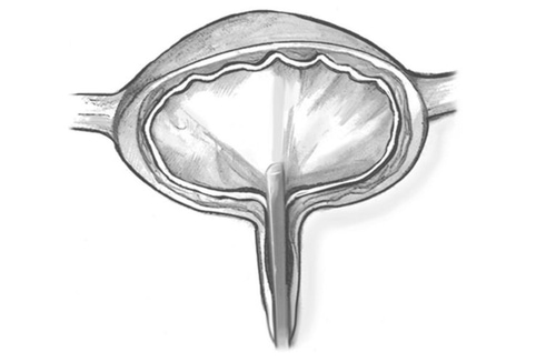 Urethral Stenosis / Stricture Treatment In Vadodara