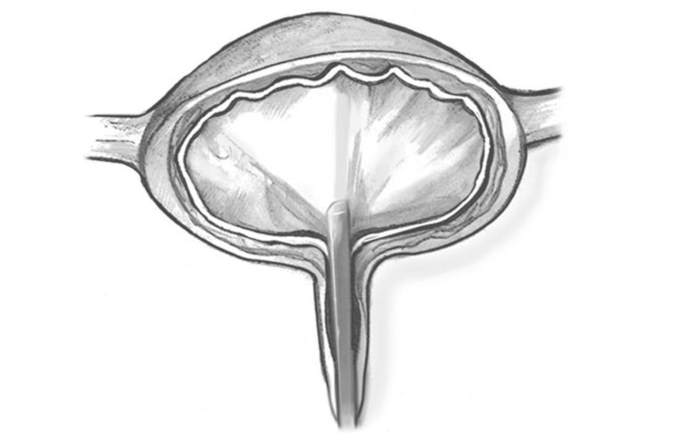 Cystoscopy And Urethral Dilation In Women – ARJF